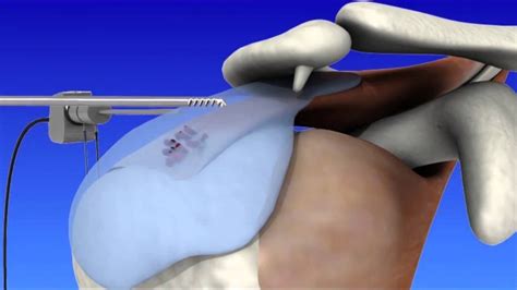Shoulder Arthroscopy Youtube