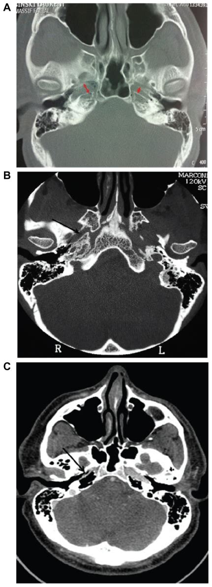 Ct Scan Of The Base Of The Skull Showing Hypoplastic Carotid Canal At