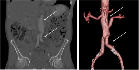 Unveiling Aortic Angiosarcoma A Rare And Aggressive Vascular
