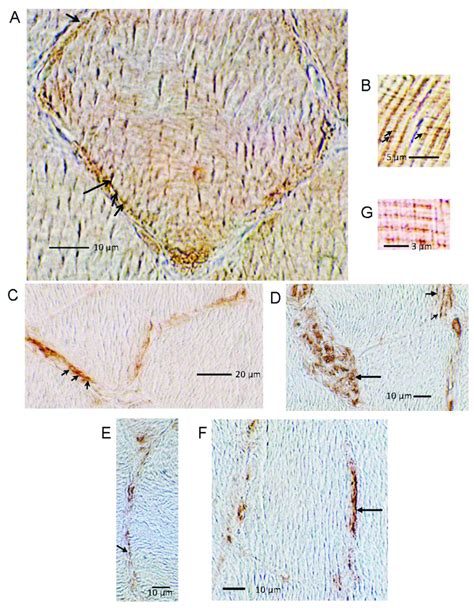 Dysferlin And Annexin A2 Detected With 33 Diaminobenzidine Dab