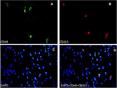 Cd68cd163 Expression In M2 Macrophage In Bladder Cancer A Cd68