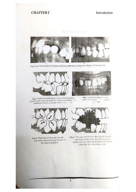 SOLUTION Removable Partial Denture RPD Studypool