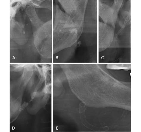 Exemplary Demonstration Of Different Calcification Foci Parotid Gland