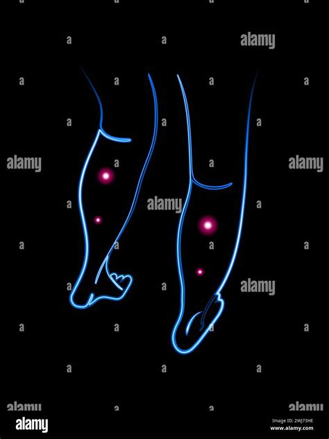 Varicose Veins Of The Legs Treatment Of Varicose Veins Stock Vector