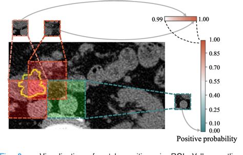 Figure 1 From Causality Driven Graph Neural Network For Early Diagnosis Of Pancreatic Cancer In