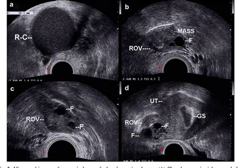 Ultrasound Video Showing A Large Chocolate Ovarian Cyst And A Smaller