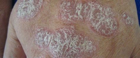 Ayurvedic Treatment For Plaque Psoriasis In Pune Dr Manoj Deshpande