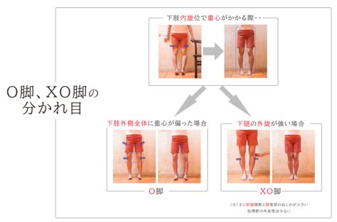【最新版】o脚、x脚、xo脚の原因と100の結果が出せる治療法 東京、埼玉で骨盤矯正、o脚矯正を学ぶならメディカル（医学的）骨盤・o脚