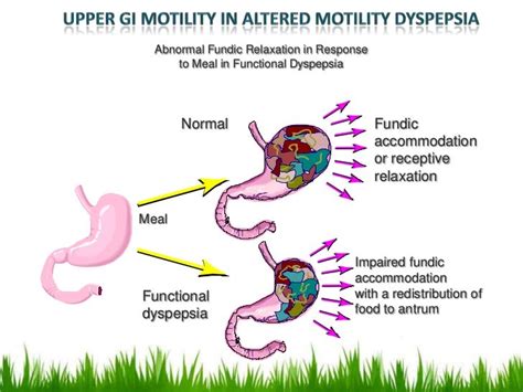 Dyspepsia