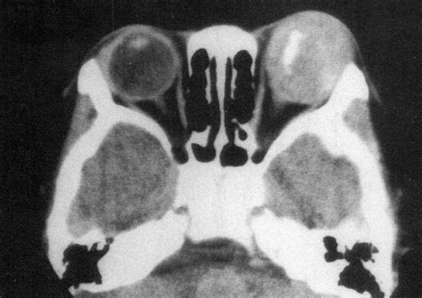 一、视网膜母细胞瘤 眼耳鼻咽喉疾病影像学图鉴