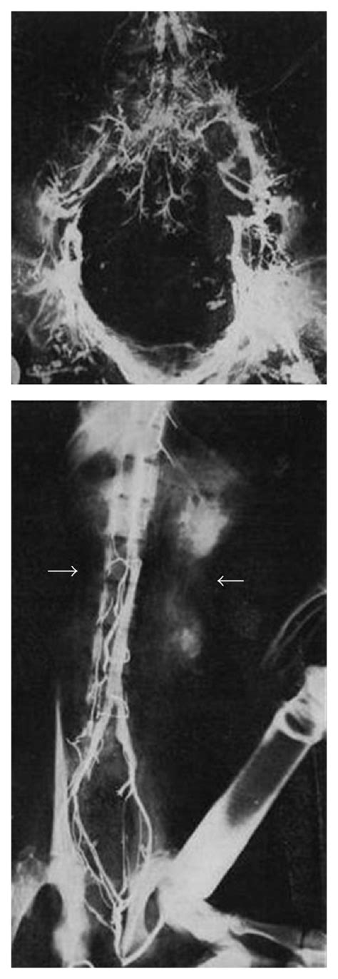 Batson Venous Plexus From Batson Ov “the Function Of The Vertebral