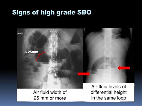 Ppt Adhesive Small Bowel Obstruction Powerpoint Presentation Id 6722760