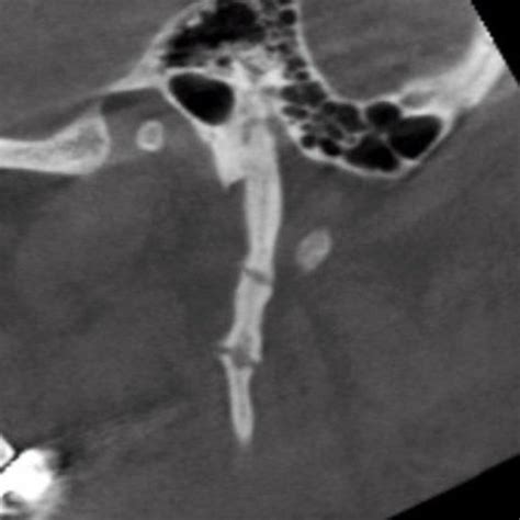 A Completely Calcified Long Styloid Process Sp Download Scientific