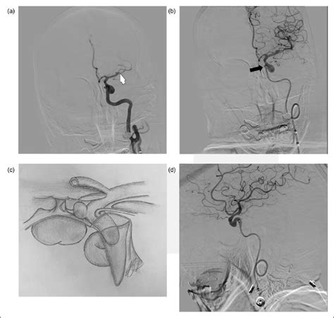 A Angiography Dsa Demonstrates The Point Of Obstruction White