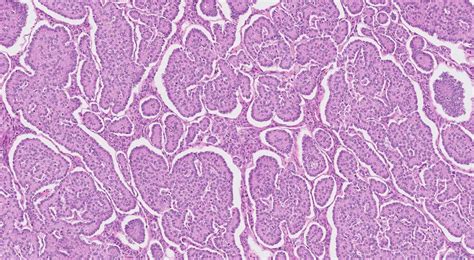 Adult Type Granulosa Cell Tumour Ottawa Atlas Of Pathology