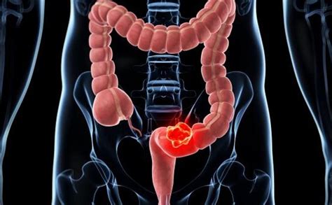 Estos son los síntomas que alertan del cáncer de colon hazles caso El Cuarto Poder