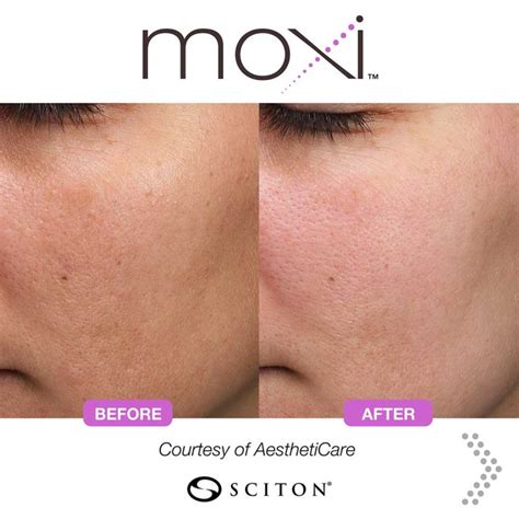 Moxi Interlocks MedSpa