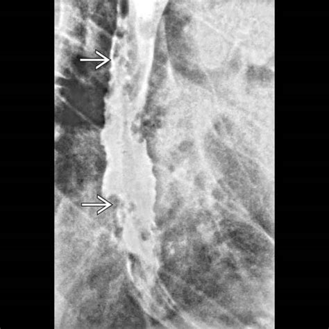 Portal Hypertension And Varices Radiology Key