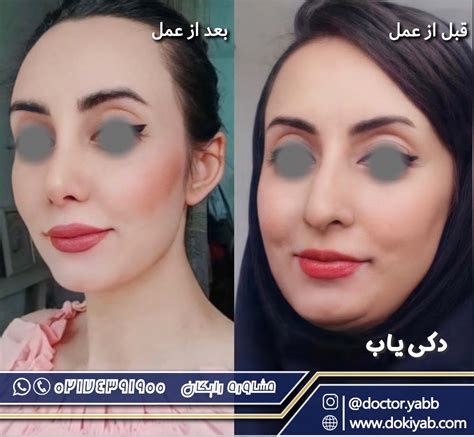 همه چیز در رابطه با دکتر ونون آصفی جراح بینی در شیراز هزینه نمونه کار