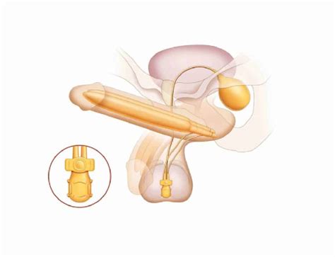 Penile Implant In India Penile Prosthesis In India Dr Nitesh Lamoria