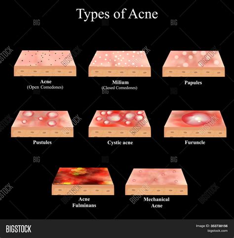 Nodular Acne Diagram