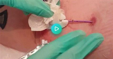 Anyone Like Picc Lines  On Imgur