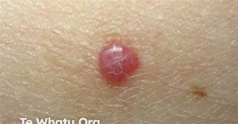 Cherry Angioma Image