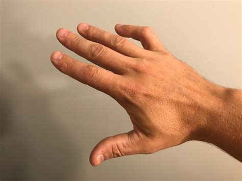 Boutonniere Deformity · Hand And Ortho