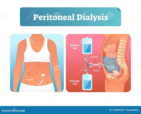 Peritoneal Dialysis Renal Insufficiency Vector Illustration
