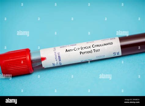 Anti Ccp Cyclic Citrullinated Peptide Test This Test Measures The