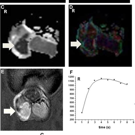 Right Testicular Seminoma In A 42 Year Old Man Invading The Testicular Download Scientific