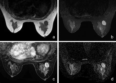 A 53 Year Old Woman With Fibroadenoma In The Right Breast A A Mass