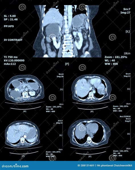 Ct Scan Abdomen And Body Stock Image Image Of Liver 288131469
