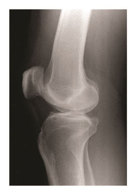 Pre And Postreduction Lateral Radiographs Show Superior Dislocation Of