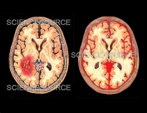 Subdural Hemorrhage Vs Subarachnoid Hemorrhage