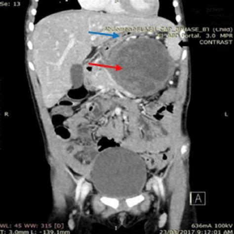 Cystic Mass Red Arrow In The Distal Pancreas And Its Relationship To Cystic Mass Red Arrow In The Distal Pancreas And Its Relationship To