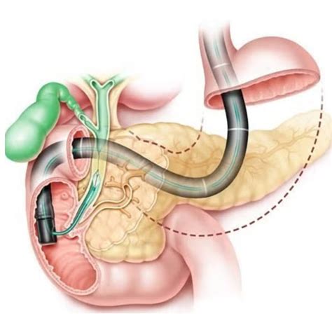Cpre Endodx Endoscopía Cuernavaca
