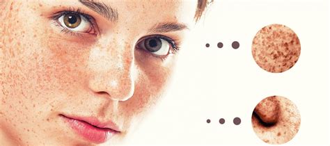 4 Claves Para Prevenir Y Tratar El Melanoma
