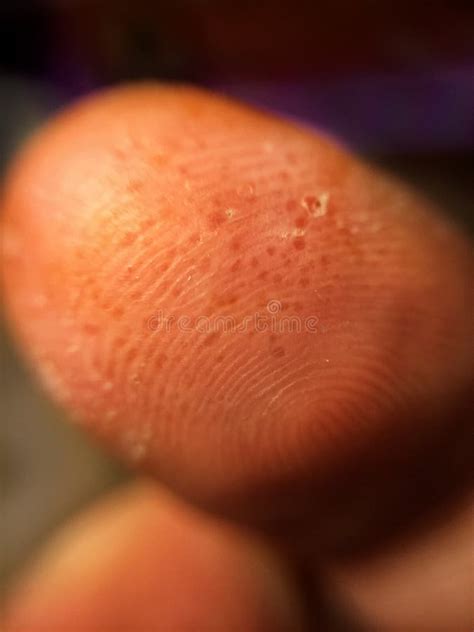 Pompholyx Stock Image Image Of Finger Problem Dermatology 96952495