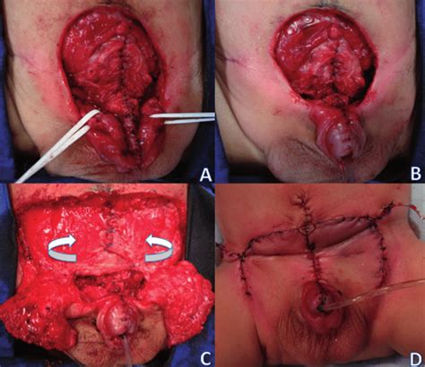 Steps Of One Stage Reconstruction A Closure Of The Bladder And