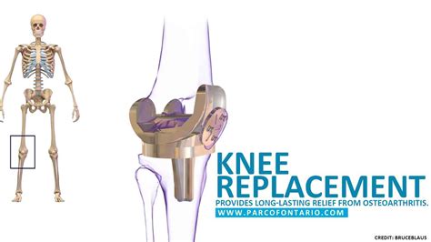 Partial Vs Total Knee Replacement Which Is The Better Option The