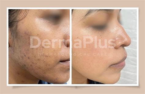 Dermaplus Metepec Dermaplus Metepec • Instagram Photos And Videos