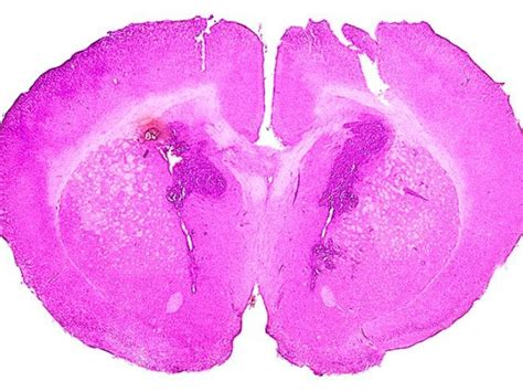 Gene Therapy For Brain Tumor Shows Promising Early Results In Humans