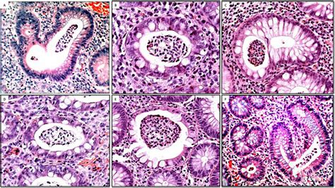 Presence Of Goblet Cells In Colon Crypts With Inflammatory Abscesses
