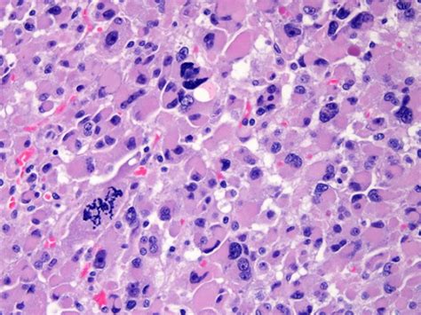 Adrenal Cancer Michigan Medicine