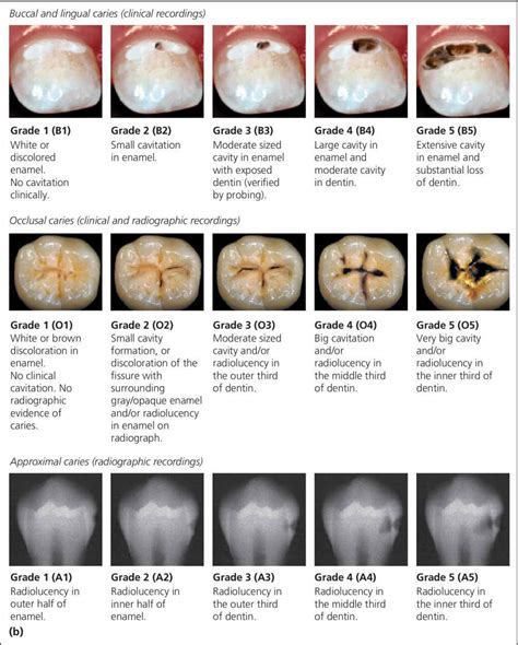 Cavity Vs Stain Chart Educational Chart Resources