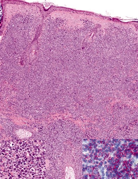 Subcutaneous Panniculitis Like T Cell Lymphoma Mostly Lobular Lymphoid