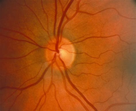 Normal Optic Disc