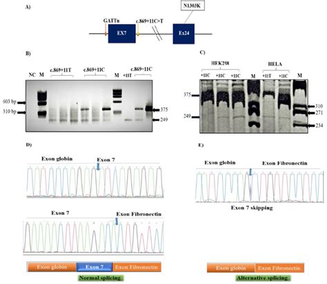 Splicing Patterns Of Examined Complex Alleles From Different Patients Download Scientific