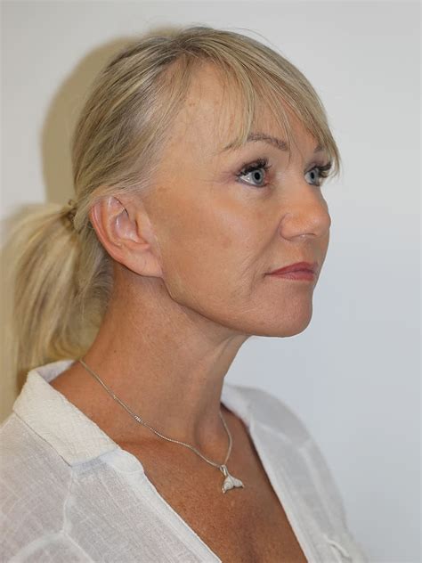 Facelift Necklift Ent Surgeon Gold Coast Dr Dan Robinson